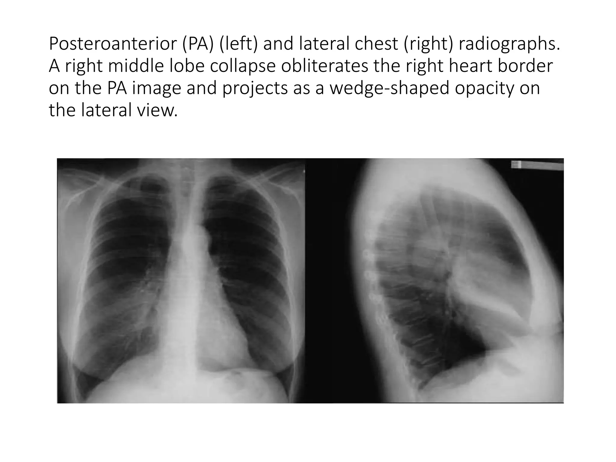 lobar collapse xray.pptx
