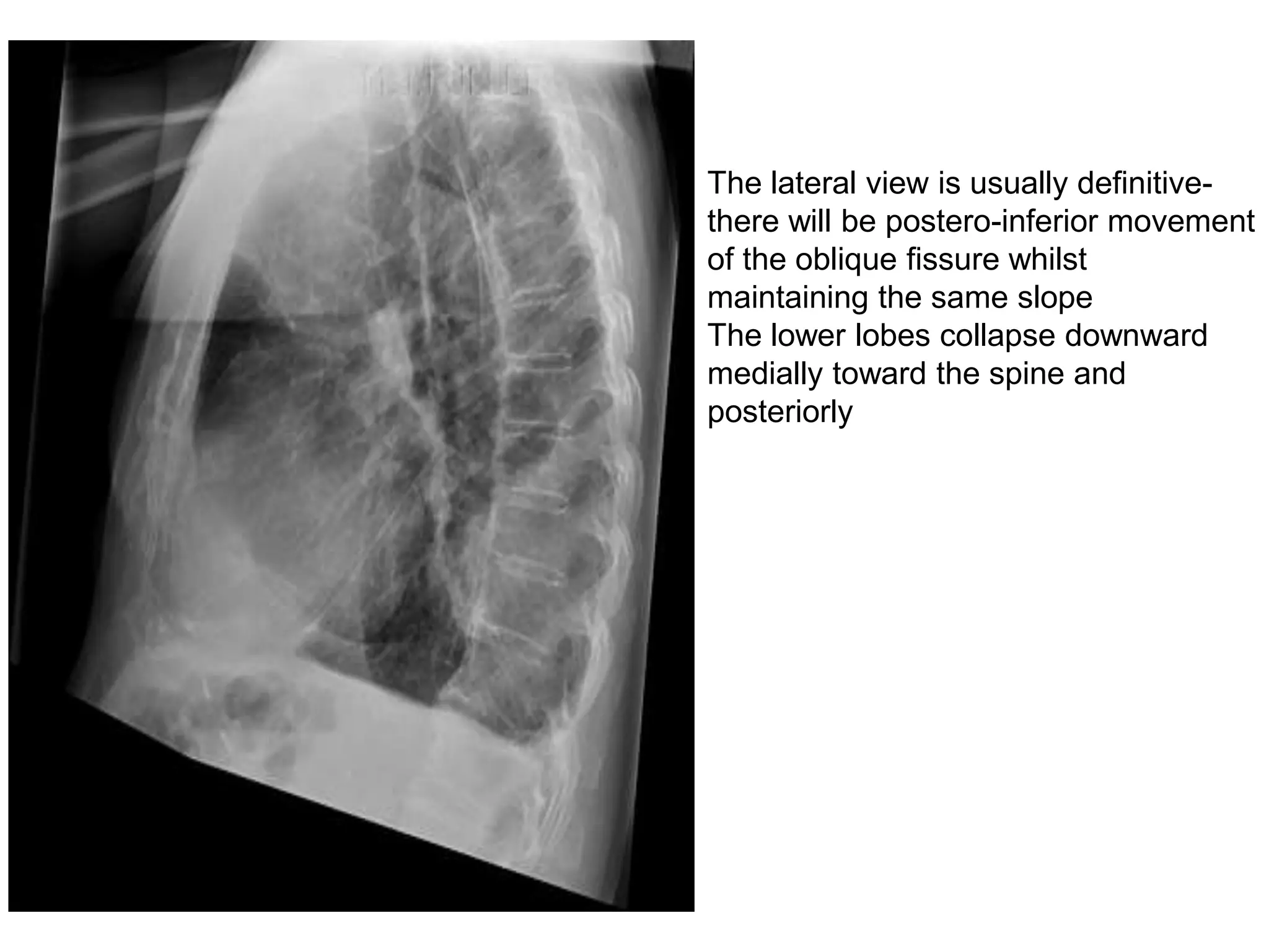 lobar collapse xray.pptx
