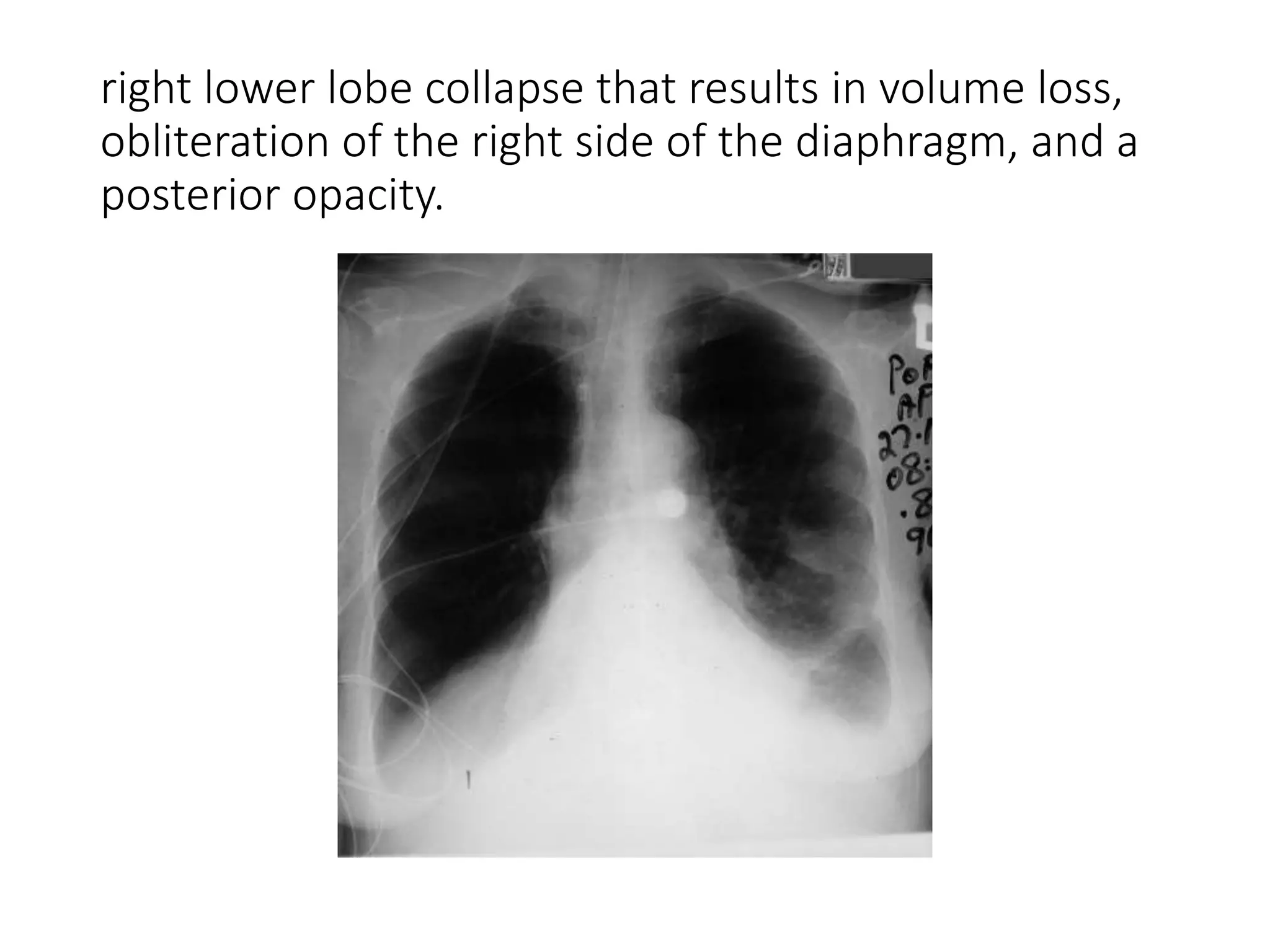 lobar collapse xray.pptx