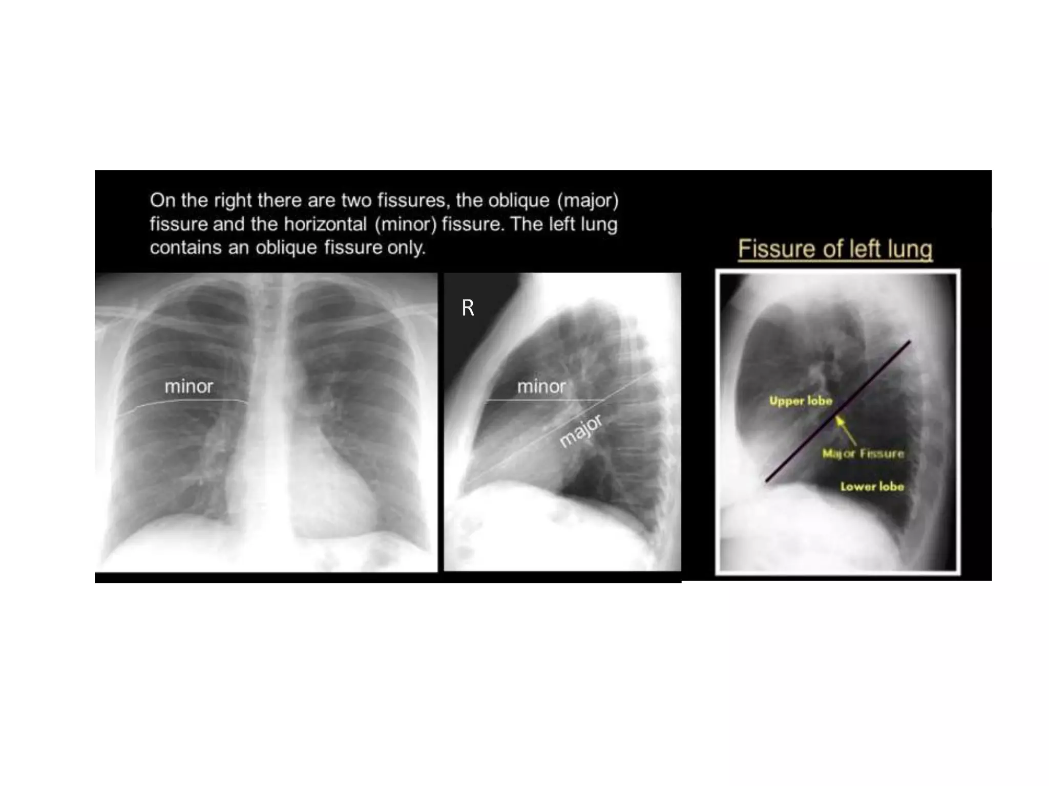 lobar collapse xray.pptx