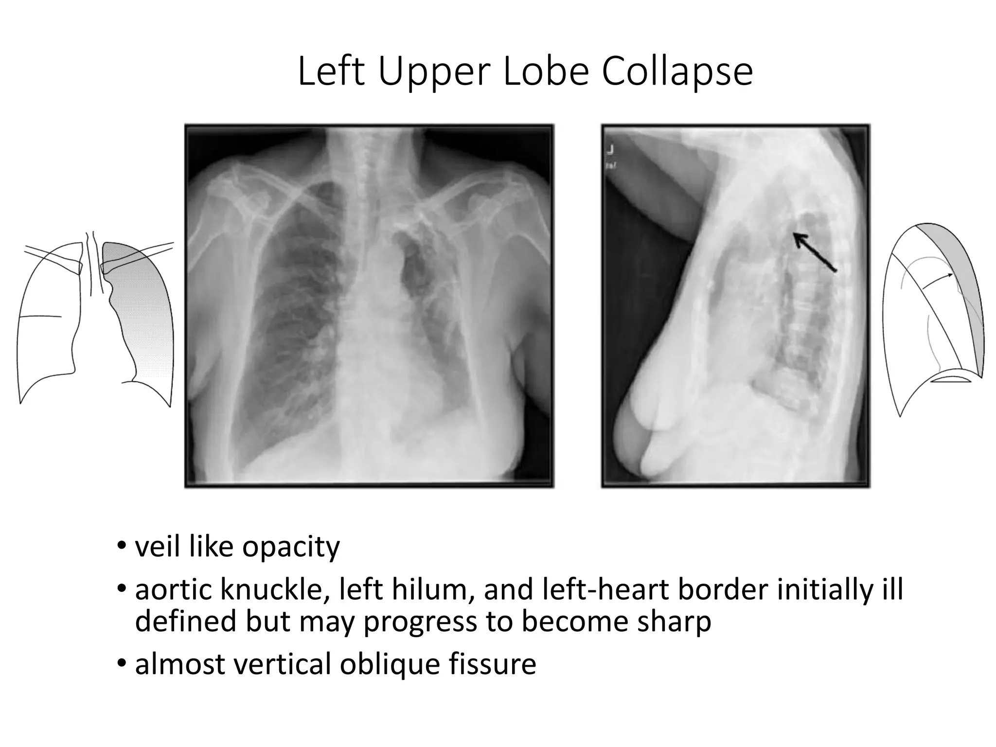 lobar collapse xray.pptx