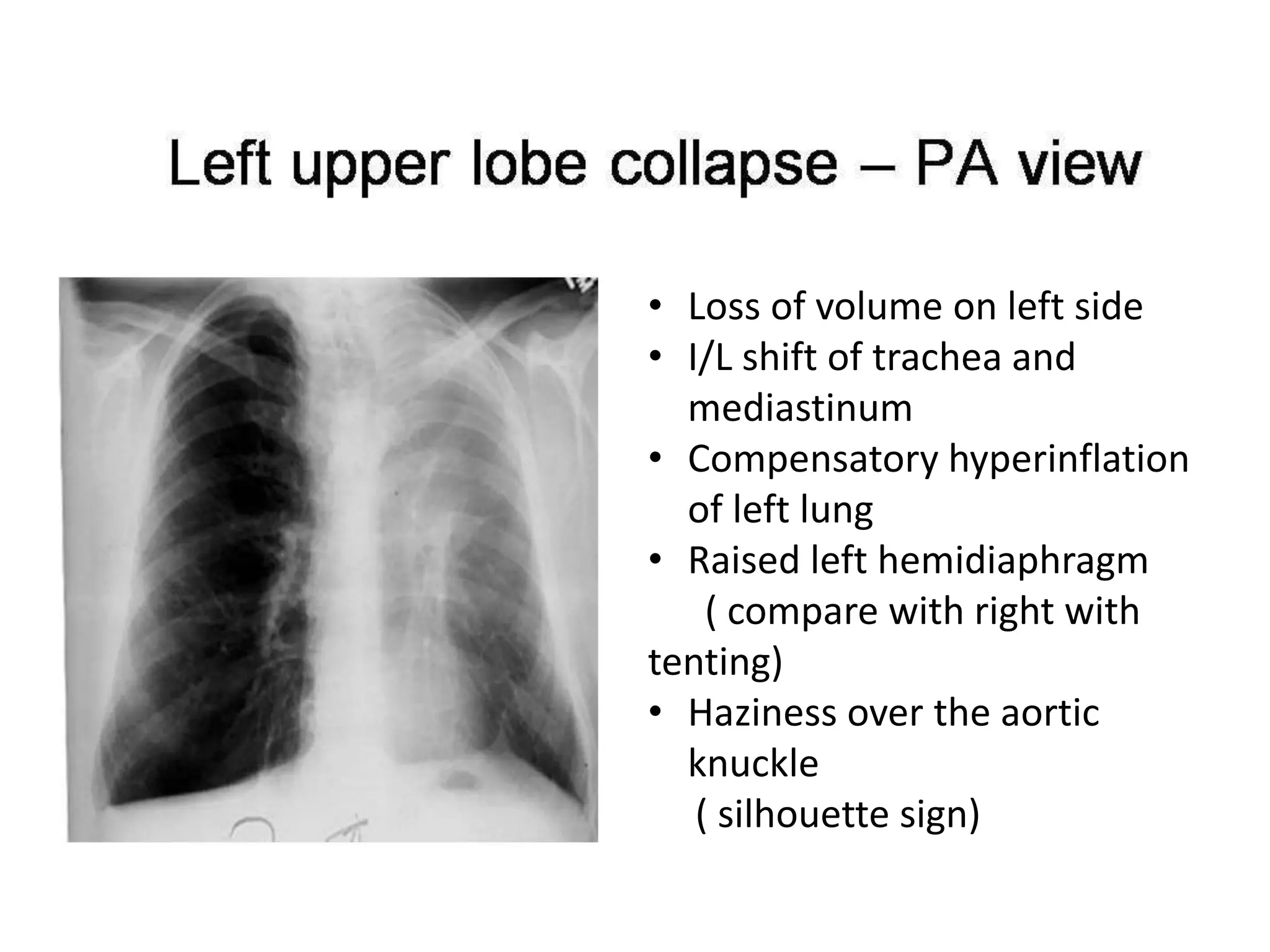 lobar collapse xray.pptx
