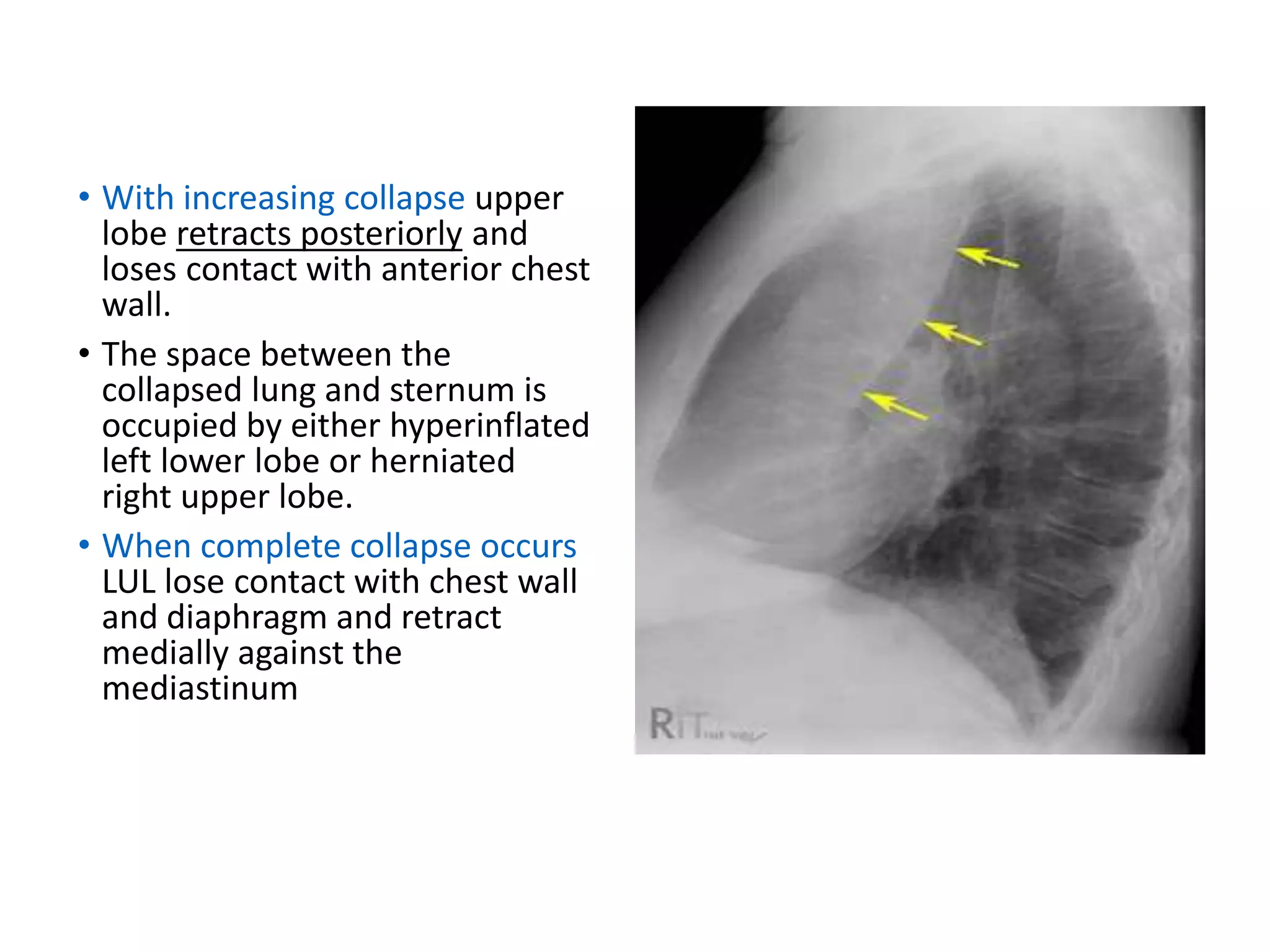 lobar collapse xray.pptx