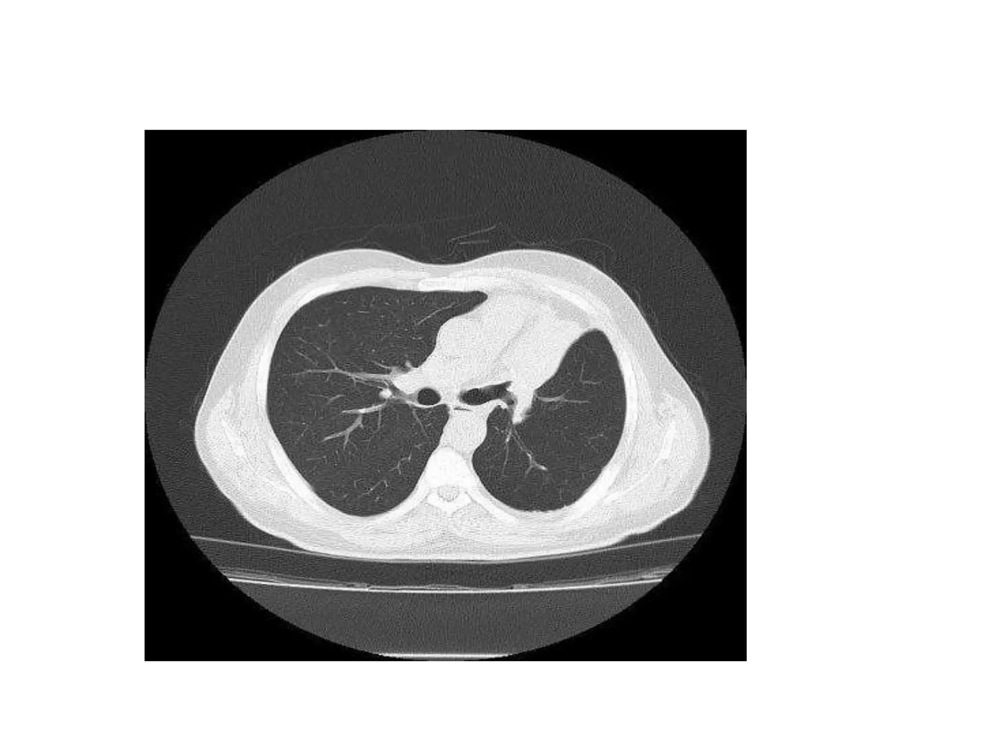 lobar collapse xray.pptx
