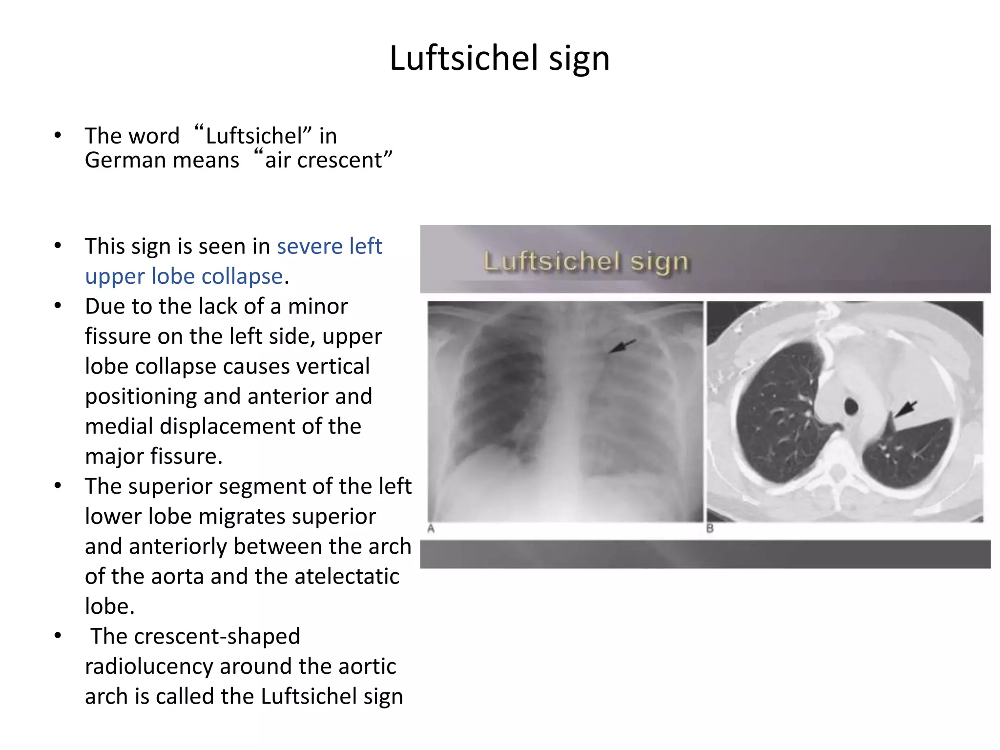 lobar collapse xray.pptx