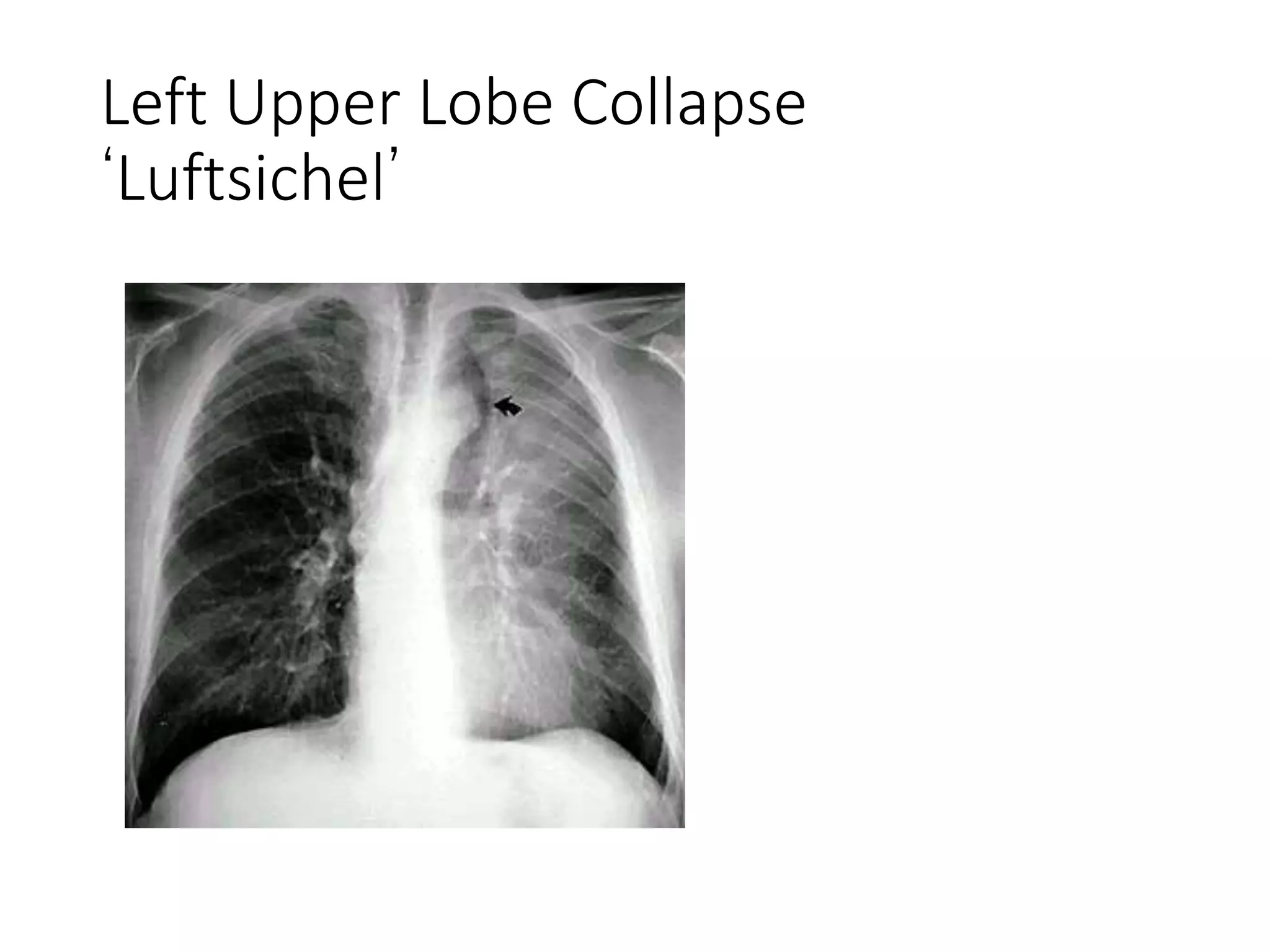 lobar collapse xray.pptx