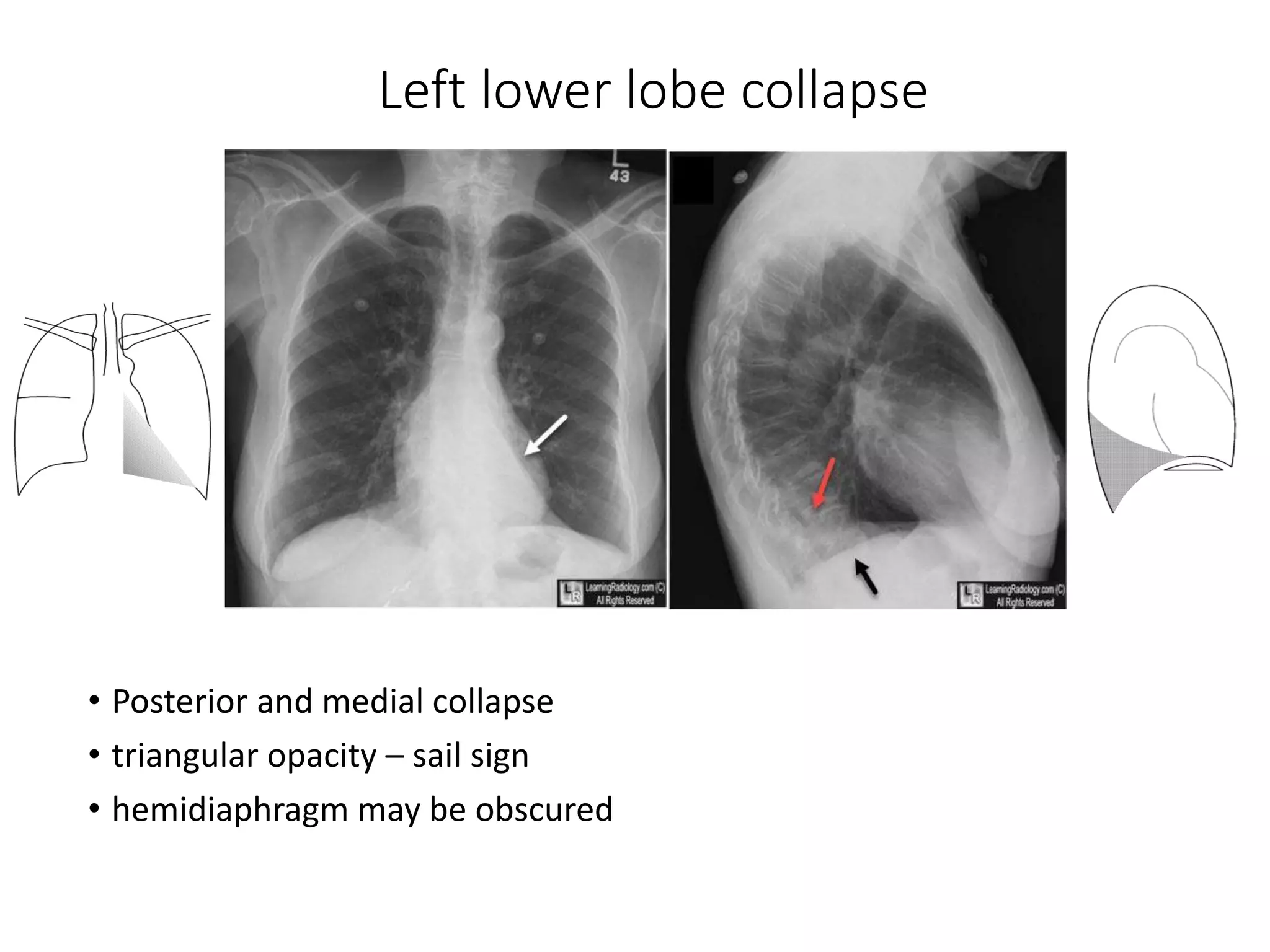 lobar collapse xray.pptx