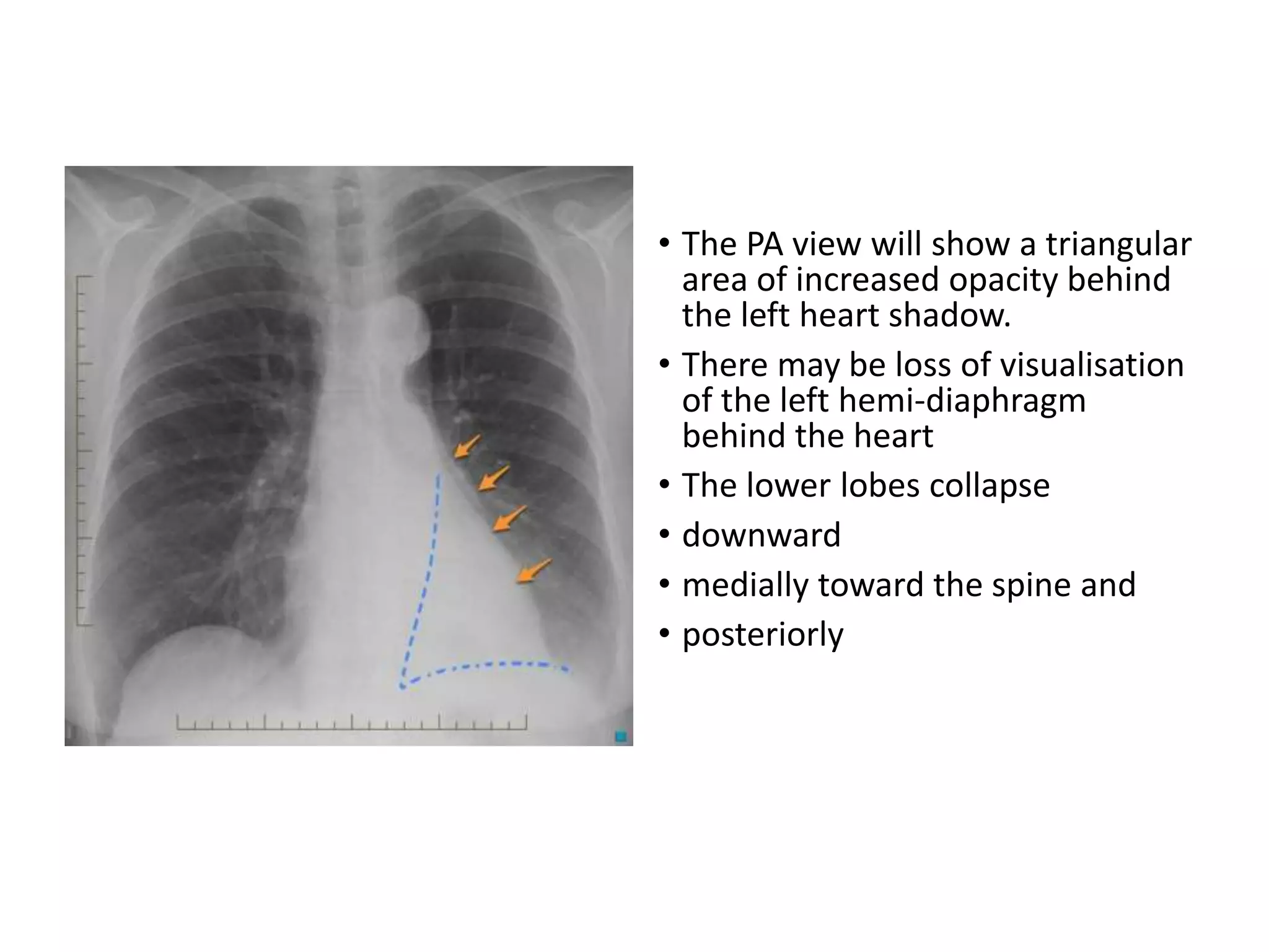 lobar collapse xray.pptx