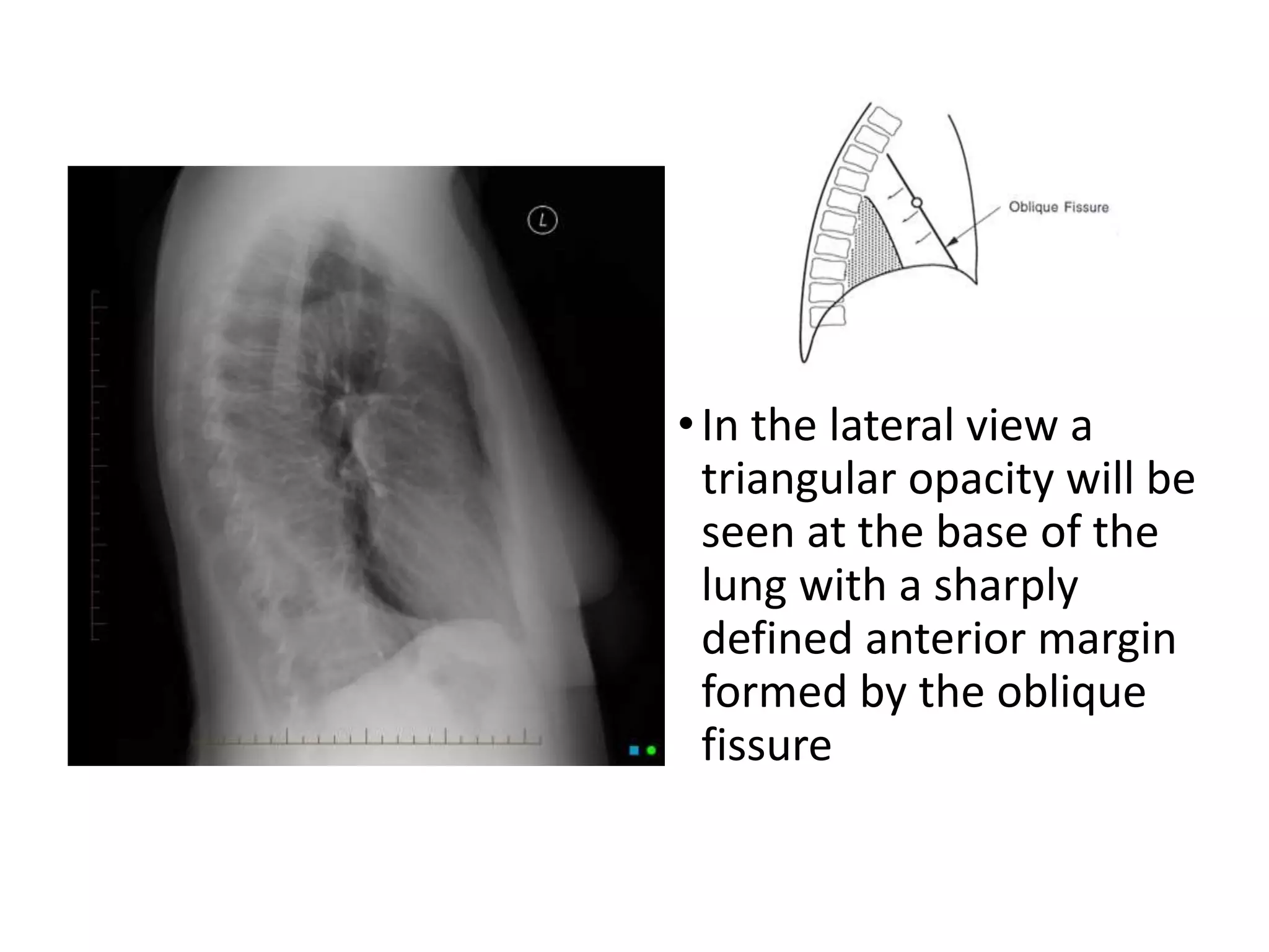 lobar collapse xray.pptx