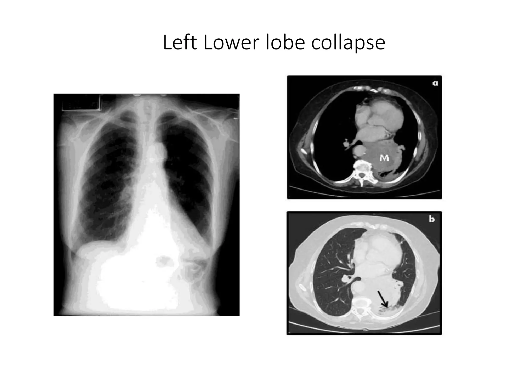 lobar collapse xray.pptx