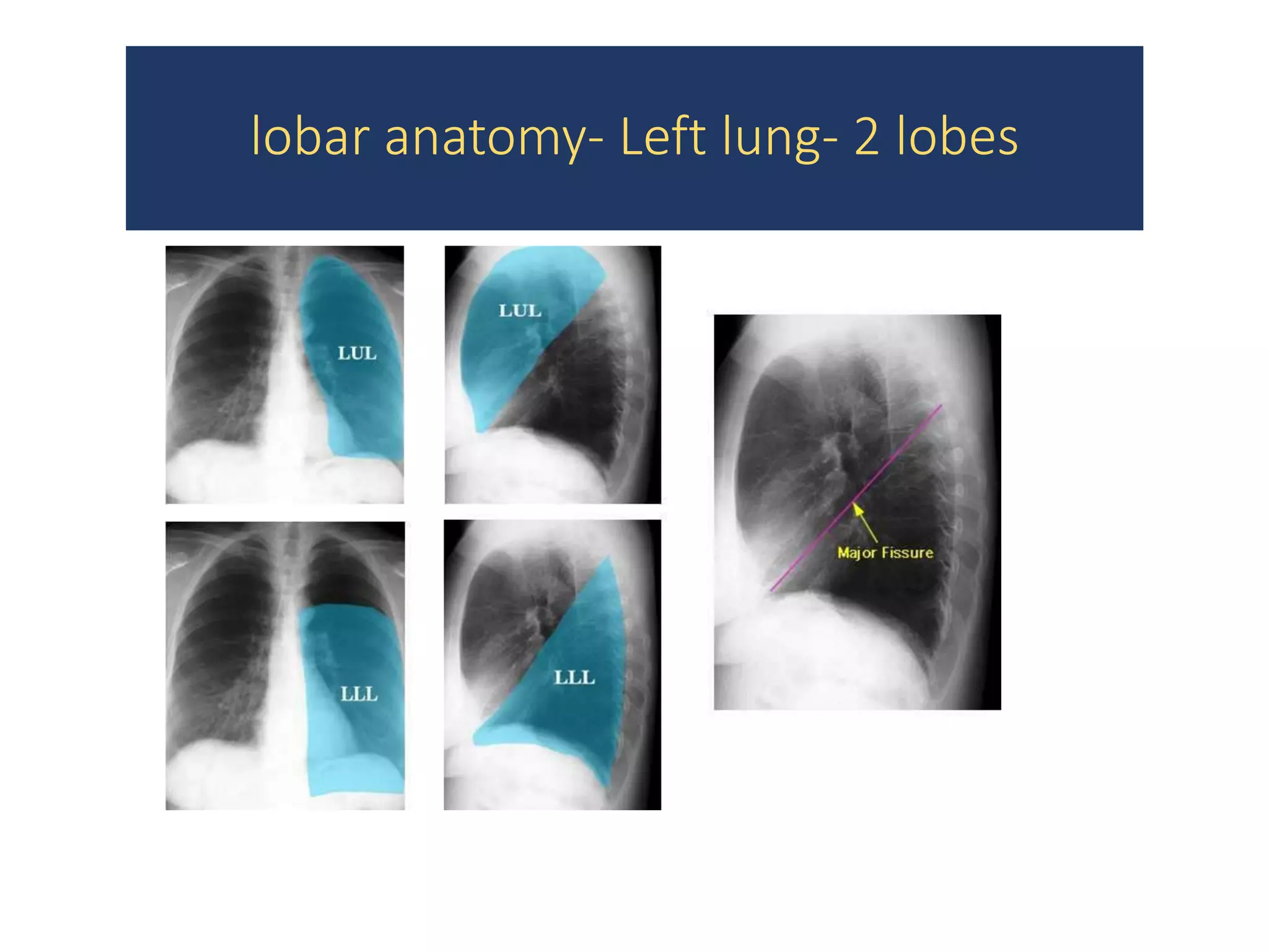 lobar collapse xray.pptx