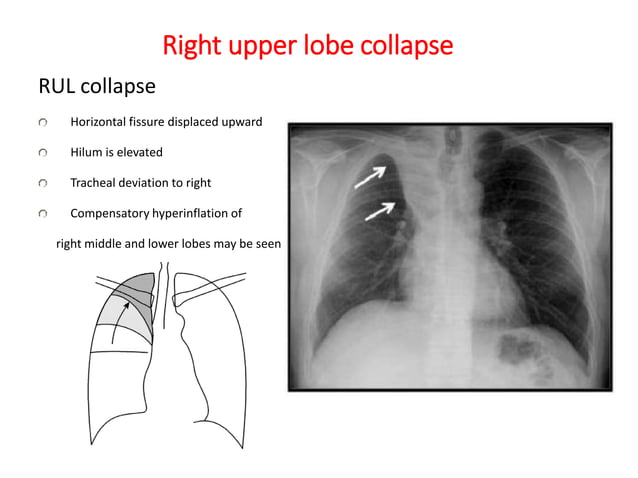 lobar collapse xray.pptx
