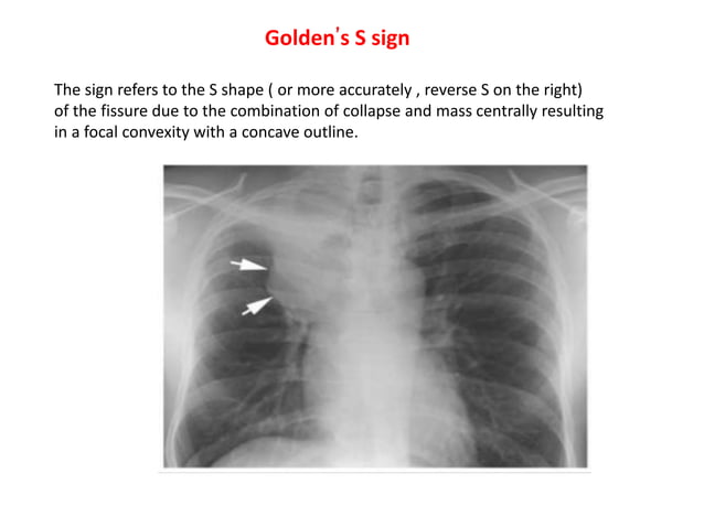 lobar collapse xray.pptx