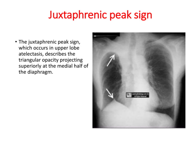 lobar collapse xray.pptx