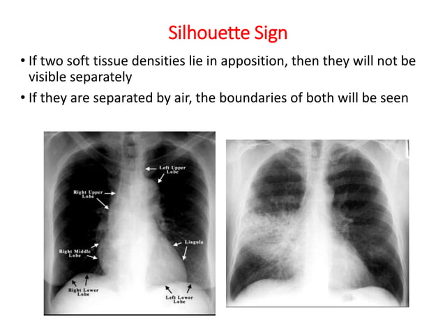 lobar collapse xray.pptx