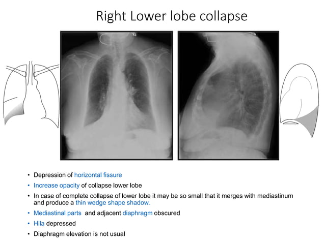 lobar collapse xray.pptx