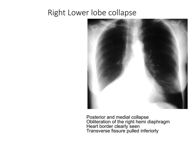 lobar collapse xray.pptx