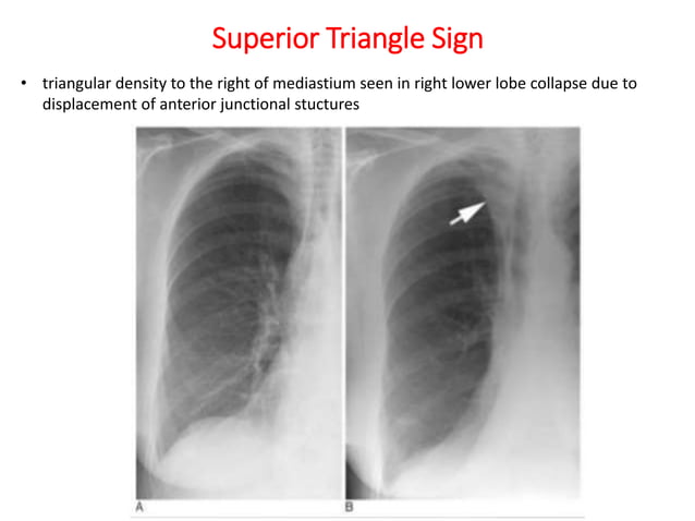 lobar collapse xray.pptx