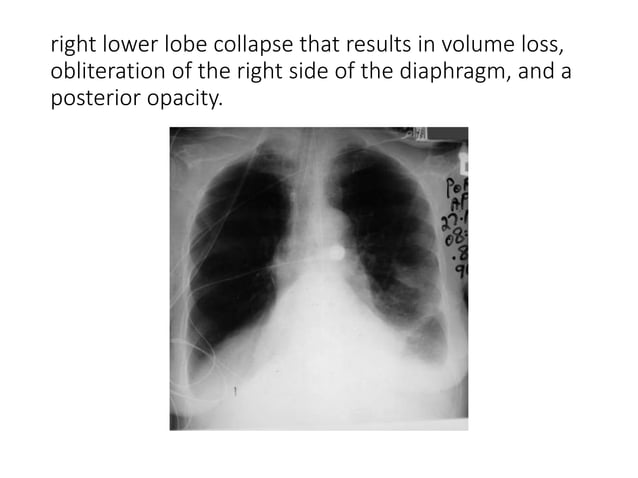 lobar collapse xray.pptx