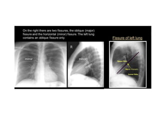lobar collapse xray.pptx