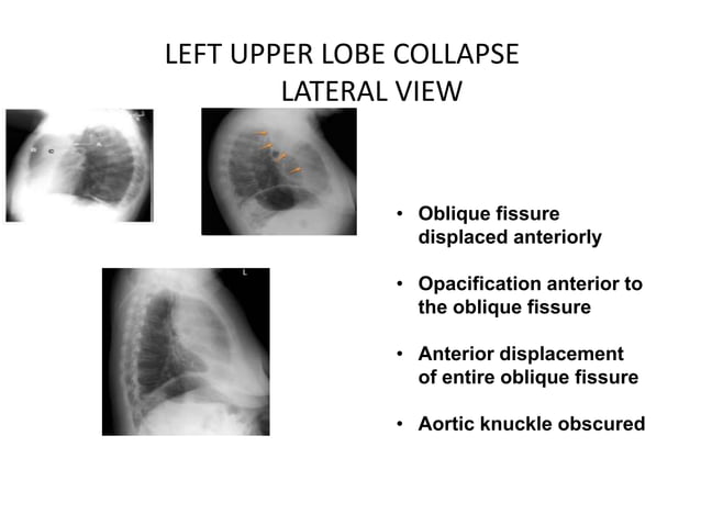 lobar collapse xray.pptx