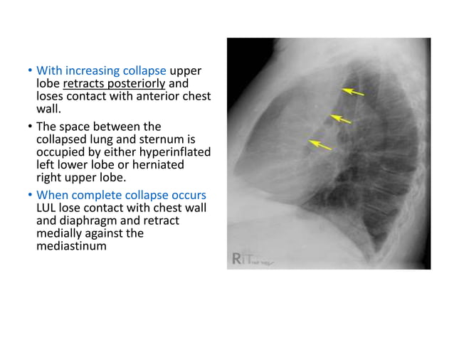lobar collapse xray.pptx