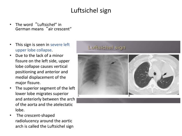 lobar collapse xray.pptx