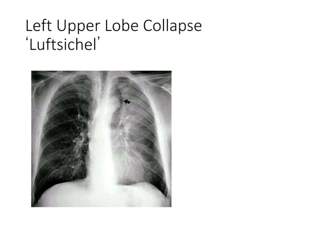 lobar collapse xray.pptx
