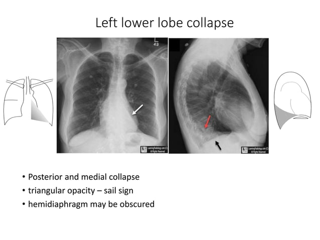 lobar collapse xray.pptx
