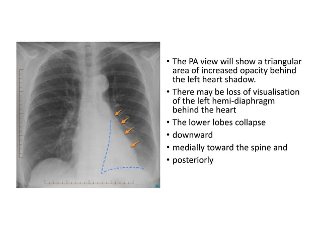 lobar collapse xray.pptx
