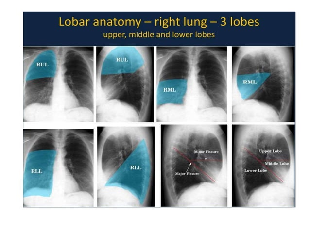 lobar collapse xray.pptx