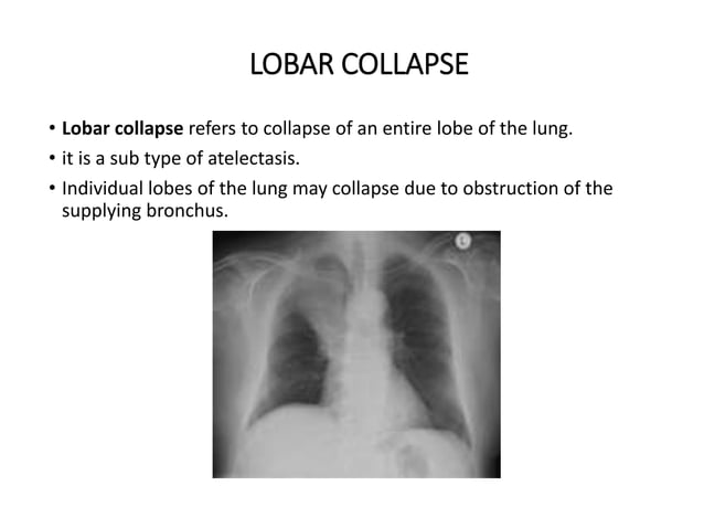 lobar collapse xray.pptx