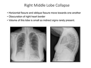 Right Middle Lobe Collapse X Ray