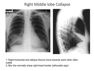 lobar collapse xray.pptx