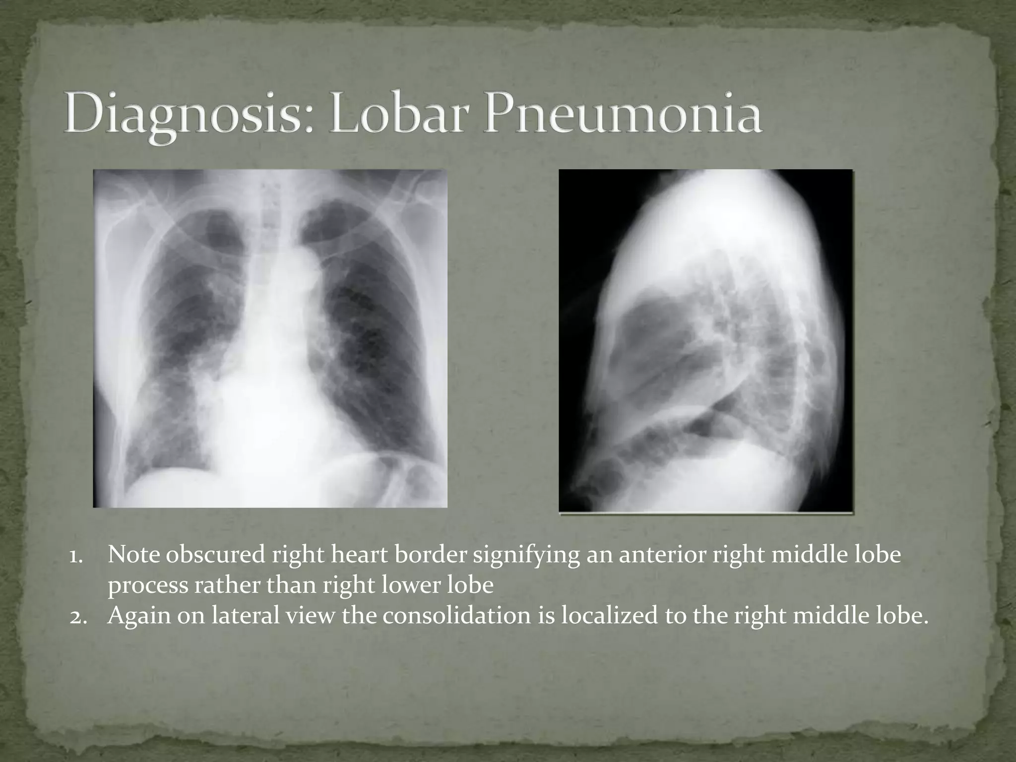 Lobar pneumonia Power Point | PPTX