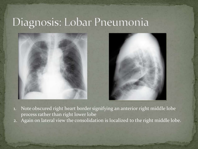 Lobar pneumonia Power Point