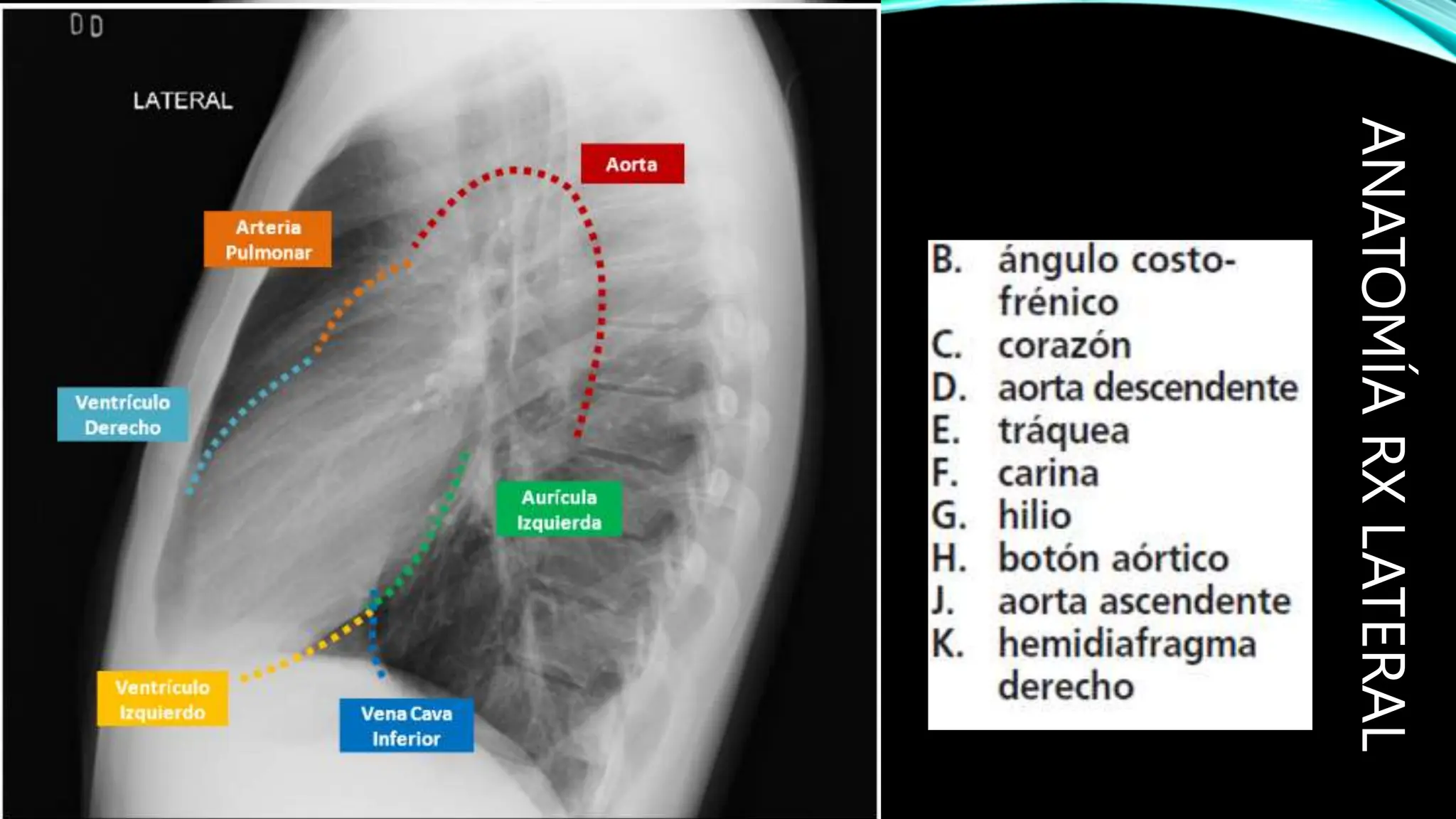 LO BASICO DE RX DE TORAX.pptx