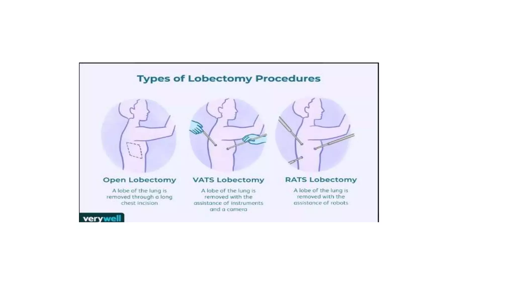Lobectomy | PPTX