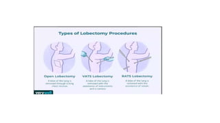 Lobectomy | PPTX