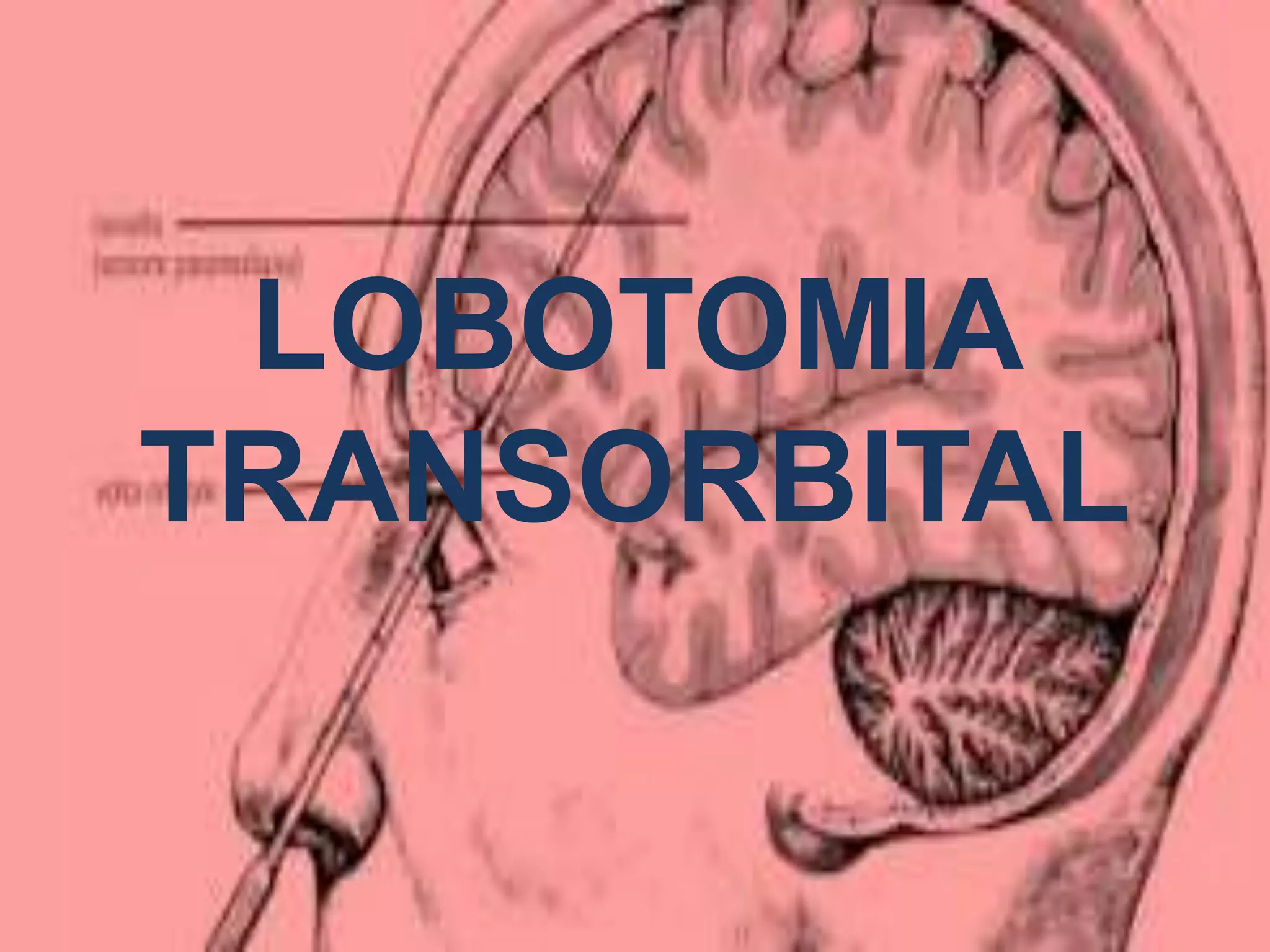 Lobotomia transorbital | PPT