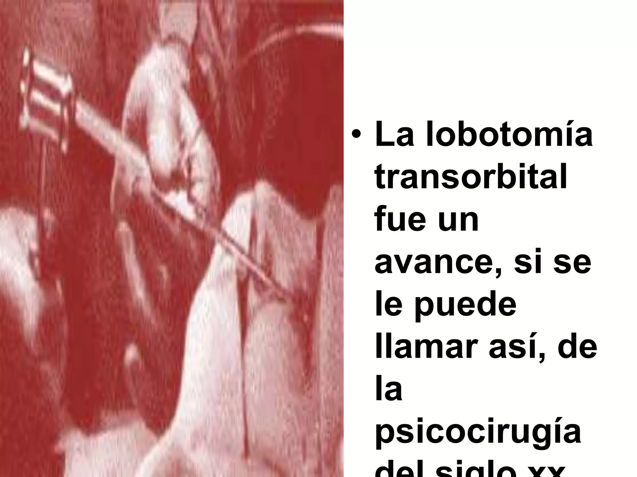 Lobotomia transorbital | PPT