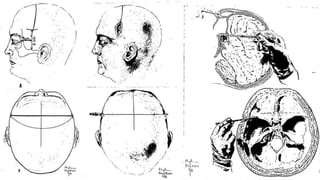procedure in prefrontal lobotomy and the history of lobotomy | PPTX