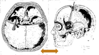 procedure in prefrontal lobotomy and the history of lobotomy | PPTX