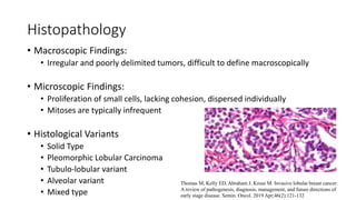 Lobular carcinoma of breast | PPTX
