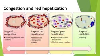 lobular pneumonia..pptx