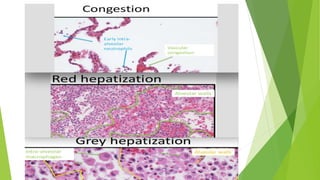 lobular pneumonia..pptx