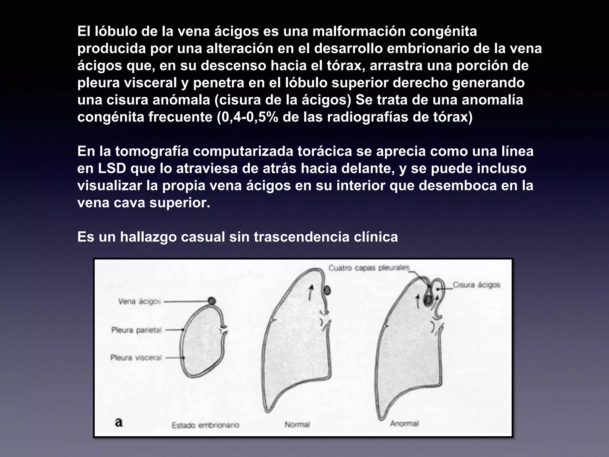Lóbulo de la ácigos | PPTX