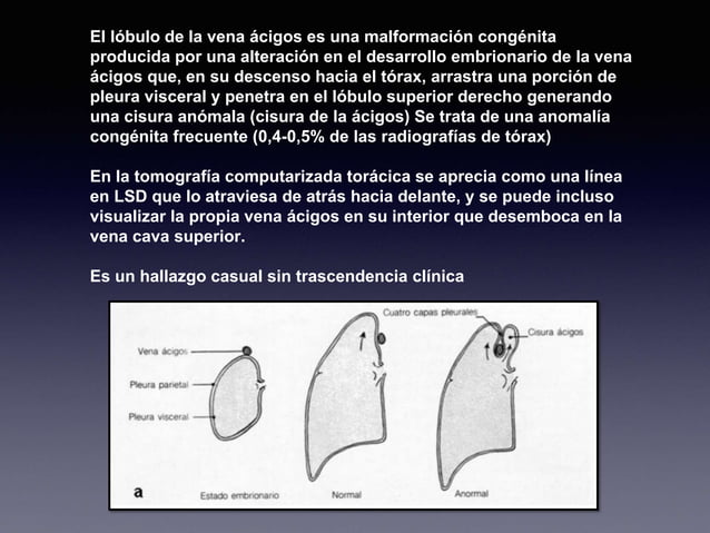 Lóbulo de la ácigos