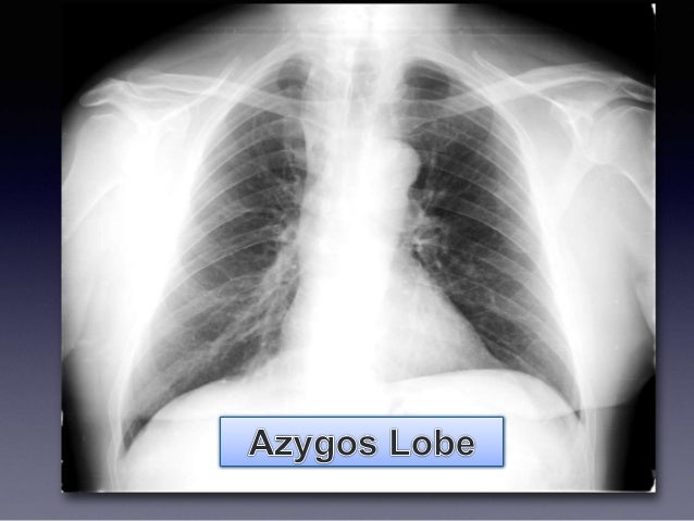 Lóbulo de la ácigos