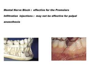 Local anaesthesia | PPT